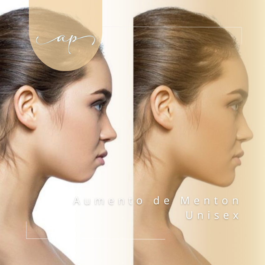 Aumento de menton